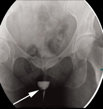 Urethral Diverticulum Female Urethral Diverticulum Radiology Case