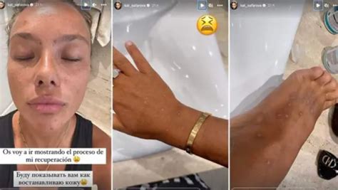 Katerina Safarova Preocupada Por Las Secuelas Que Sufre Su Cuerpo Tras