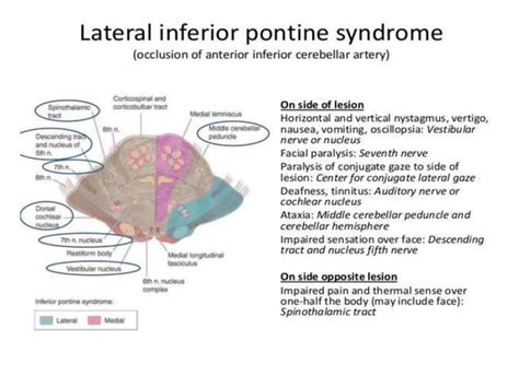 Localisation Of Stroke Pptx