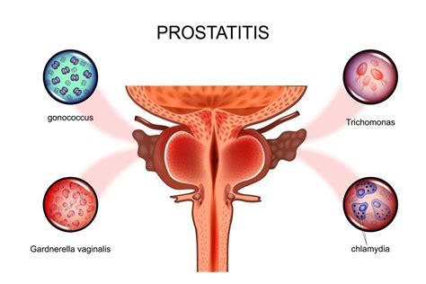 Chronic Epididymitis Causes Symptoms Diagnosis Treatment Stdgov Blog