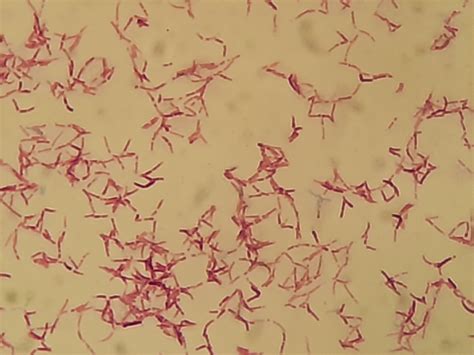 Nocardia Spp Modified Ziehl Neelsen Kinyoun Stain — Usmle High