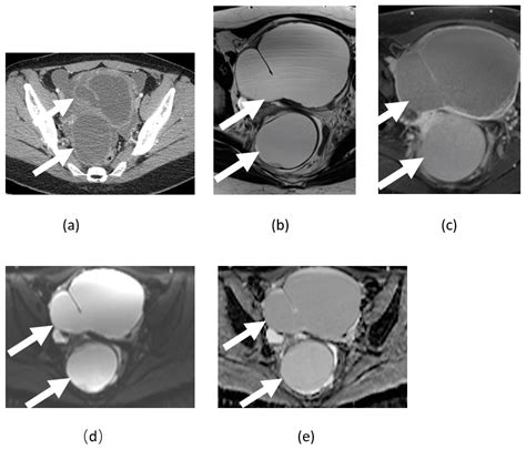 Utility Of The Diffusion Weighted Sequence In Gynecological Imaging
