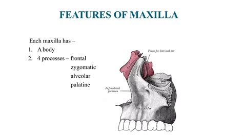 Maxillary Tuberosity Fracture Ppt