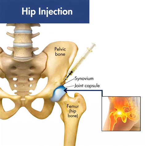 Types Of Injections For Hip Pain Relief And Treatment Guide