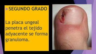 Onicocriptosis Uña Encarnada Pptx