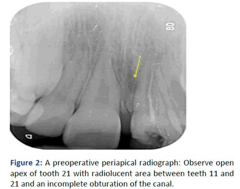 Management Of Permanent Immature Necrotic Tooth With Biodentine