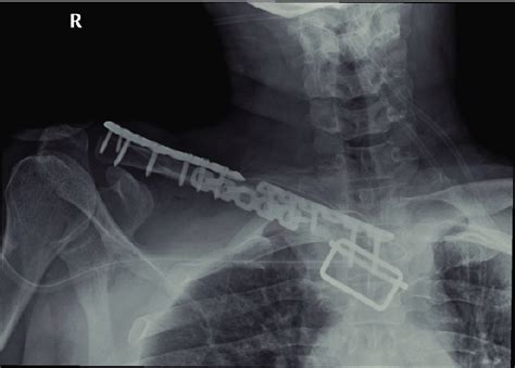 After Wide Resection And Allograft Reconstruction Three Plates And