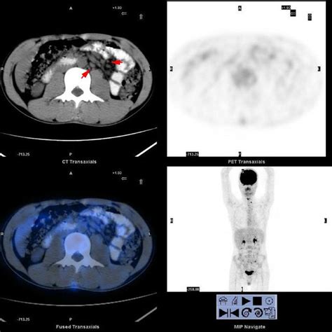 Pet Ct Revealed Multiple Enlarged Lymph Nodes Arrow In The Abdominal