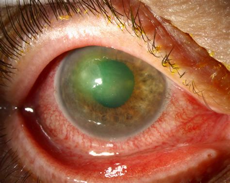 Neighborhood Level Factors Might Impact Microbial Keratitis