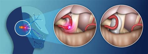 All About Trigeminal Neuralgia The Ottawa Hospital Foundation