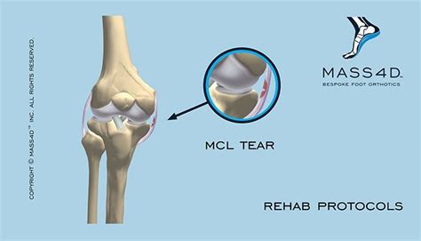 Passive To Active Protocol Progression For Mcl Partial Tear