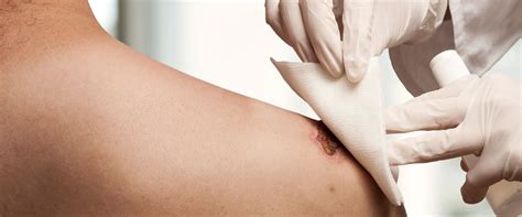 Navigating Your Treatment Options For A Denuded Skin Wound