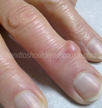 Ganglion Cyst Finger Ganglion Cyst Qzlil