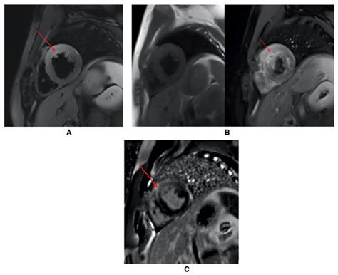 Pediatric Myocarditis Openanesthesia