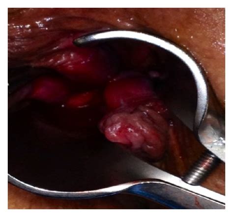Dieulafoy Lesion With Fresh Bleeding In Anal Canal Download