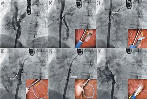 Novel Percutaneous Suture Mediated Patent Foramen Ovale Closure Technique Early Results Of The