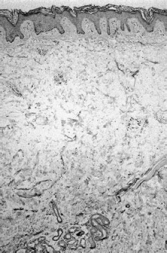 Thyroid Dermopathy And Thyroid Acropachy Oncohema Key