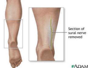 Sural Nerve Biopsy