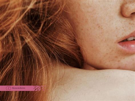 How To Get Rid Of Keratin Plugs Remotederm