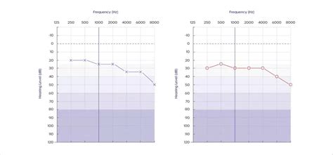 How To Interpret An Audiogram Amplivox