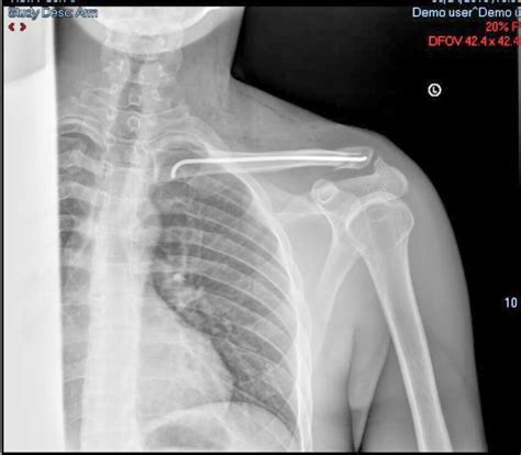 Left Clavicle X Ray