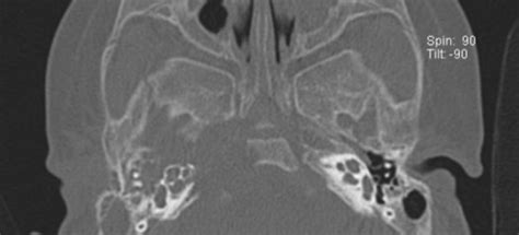 Computed Tomography Of The Temporal Bone An Expansile Osteolytic Bone Download Scientific