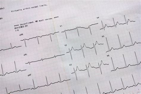 Graph Showing The Results Of The Electrocardiogram Test On Recording