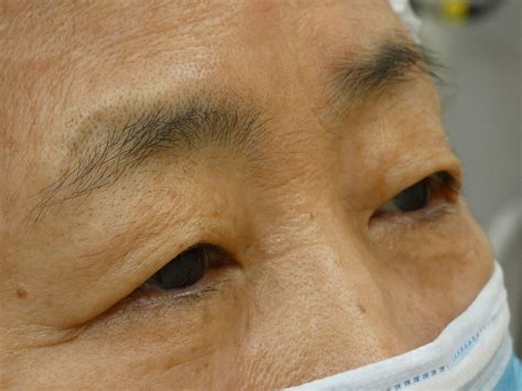 70代女性 眼瞼下垂手術 眉下切開 眼瞼下垂とアートメイクの緒方眼科クリニック｜大田区蒲田駅近く