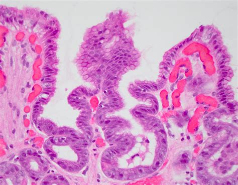 Inflammatory Papillary Hyperplasia Histology