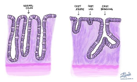 Crypt Distortion Mypathologyreportca