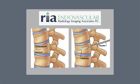 What You Need To Know About Kyphoplasty Interventional Radiology