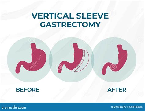 Laparoscopic Sleeve Gastrectomy Vertical Gastrectomy Weight Loss