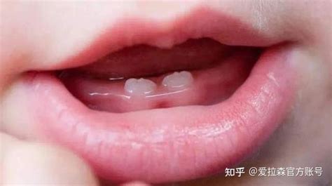 宝宝出牙晚,是缺钙?这些长牙小知识,父母越早知道越好! 知乎 宝宝出牙晚,是缺钙?这些长牙小知识,父母越早知道越好! 知乎