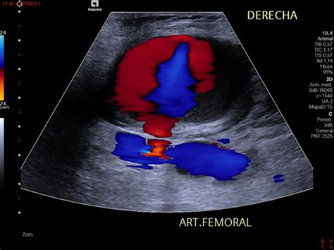 Femoral Pseudoaneurysm