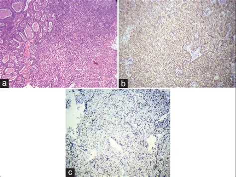 Role Of P16ink4a And Ki 67 As Specific Biomarkers For Cervical