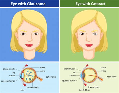 Understanding Glaucoma Types Risk Factors And Treatment Options Shree Ram Netralaya