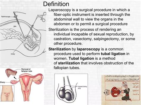 Laparoscopic Sterilization My Presentation Pptx