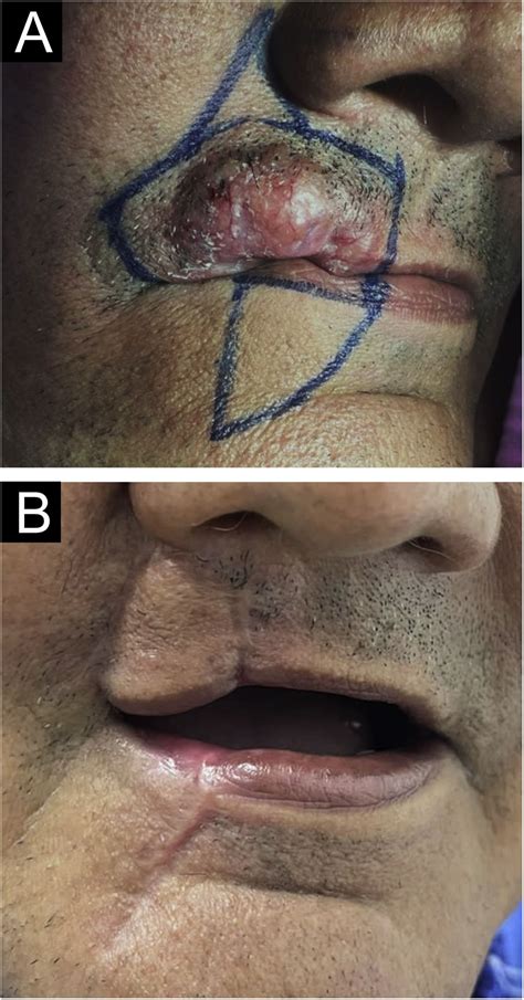 Lobomycosis Single Lesion On The Lip Anais Brasileiros De Dermatologia