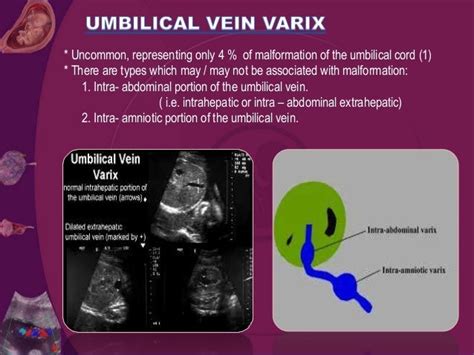 Umbilical Cord Vein Umbilical Vein Catheterization Jqmclv