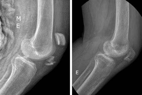 Tratamento Das Fraturas Da Patela Dr Leonardo Rocha Thomaz