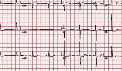Smart Pacemaker Dissolves When It Is No Longer Needed
