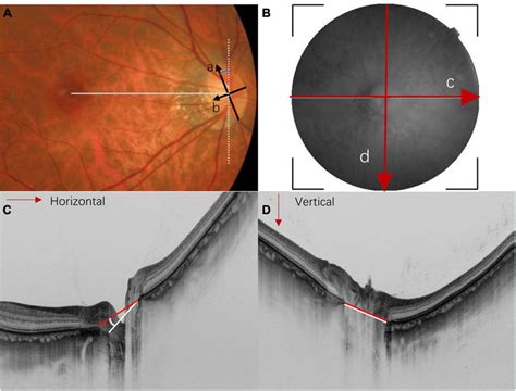 Methods For Measuring Optic Disc Torsion Ovality Index And Optical