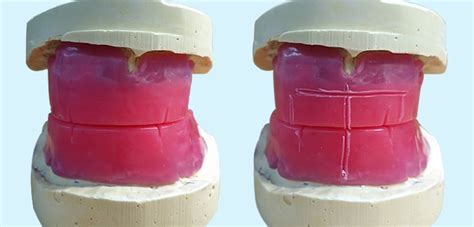 Correctly Using Your Base Plate Bite Rims To Record Measurements