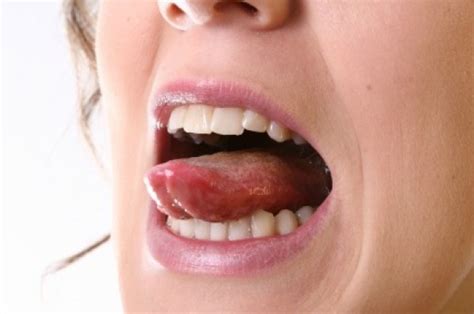 Red Sore On Tongue