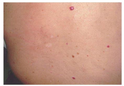 44樱桃样血管瘤 儿科学 医学