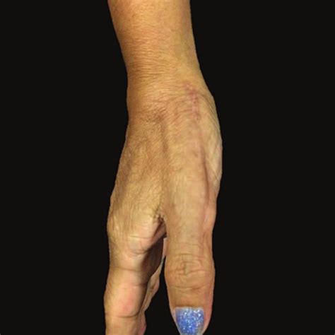 View Of Giant Cell Tumor Of Thumb Metacarpal Preoperatively Download Scientific Diagram