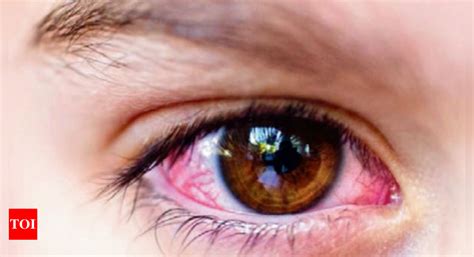 Conjunctivitis Cases Dip In State Outbreak Slows Down Mumbai News