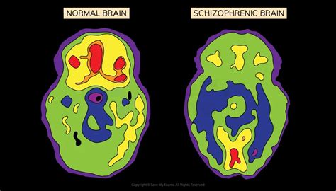 Neural Correlates Of Schizophrenia Aqa A Level Psychology Revision