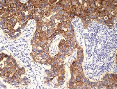 Strong Circumferential Her2 Staining In 30 Of Invasive Ductal