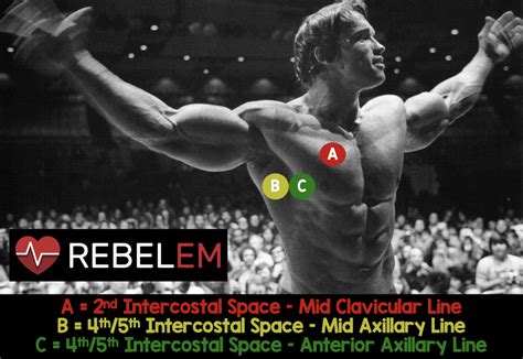 What Is The Best Anatomic Location For Needle Thoracostomy Rebel Em